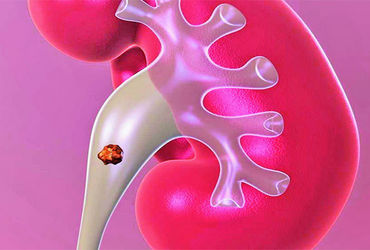 અશ્મરી-આયુર્વેદ-સારવાર . | Ashmari Ayurveda Treatment