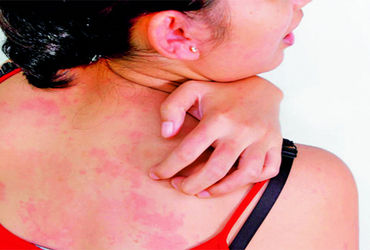સ્કીન રોગ - આયુર્વેદ સાધ્ય . | Skin Disease Ayurveda Remedy - Gujarat ...