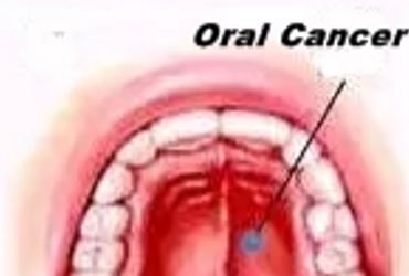 India has highest number of oral cancer cases caused by smokeless ...