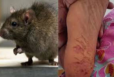 પુણે યુનિવર્સિટી 2 વિદ્યાર્થીઓને ઉંદર કરડયા બાદ હડકવાનાં લક્ષણો | 2 ...